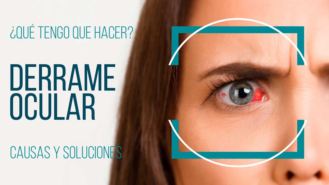 Hemorragia en el ojo: ¿Qué es un coágulo de sangre ocular y cómo ...